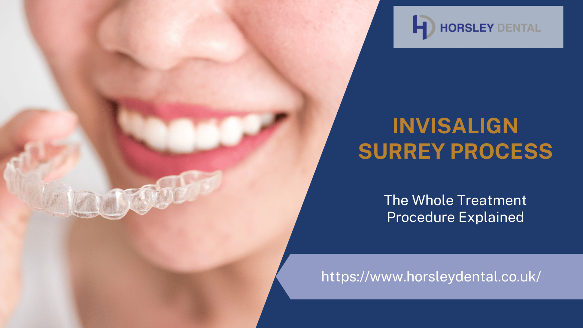 Invisalign Surrey Process: The Whole Treatment Procedure Explained ...
