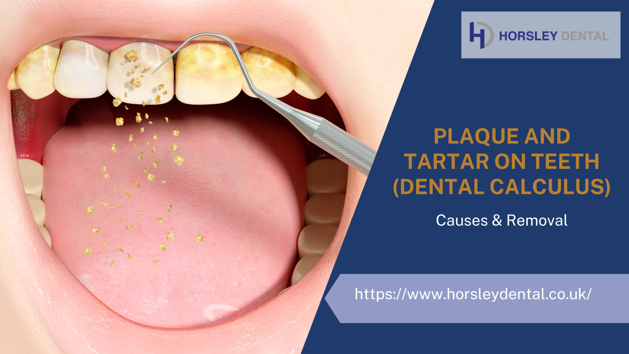 Plaque And Tartar On Teeth (Dental Calculus): Causes & Removal ...